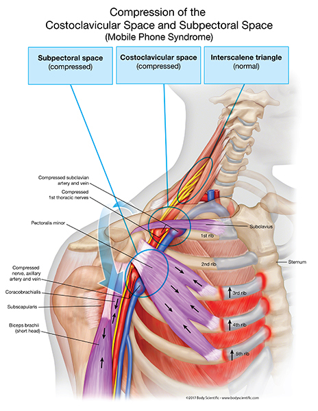 Thoracic Outlet Syndrome, Rib Resection, Recovery Stories?