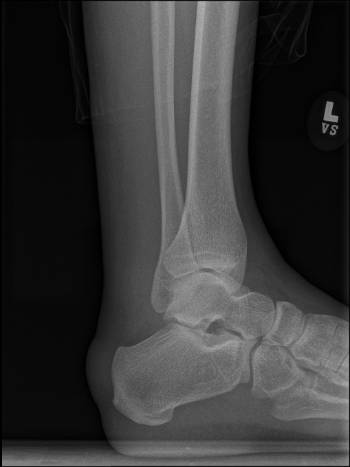 Home wall injury ATFL AND CFL TEAR docs of MP help???