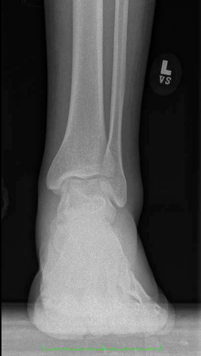 Home wall injury ATFL AND CFL TEAR docs of MP help???