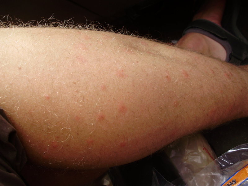 Listen to the warnings regarding bug-spray!!!