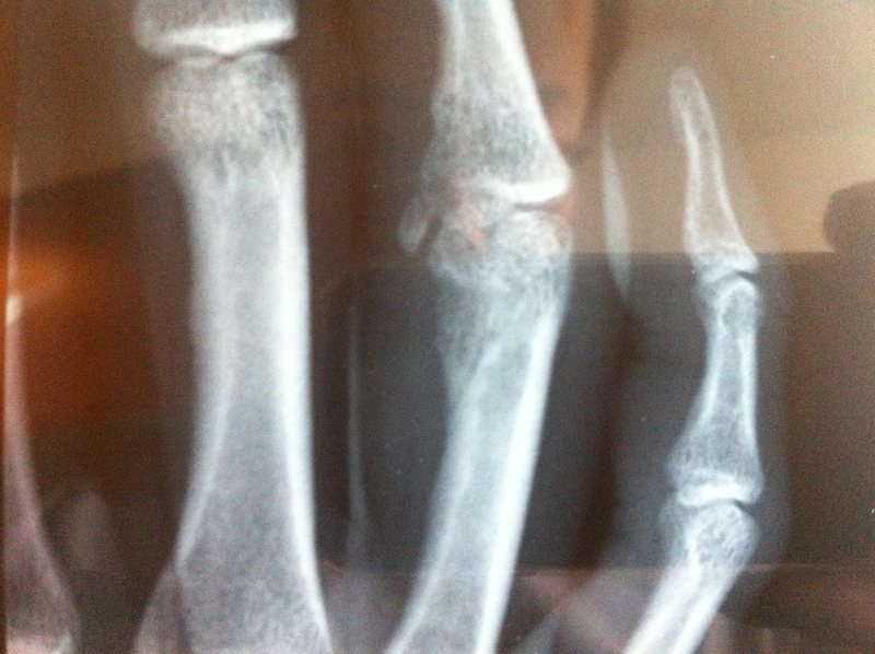 X-ray showing bone chip on right ring finger